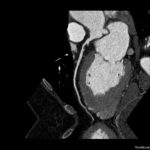CT Calcium Score - Cardiology Specialists