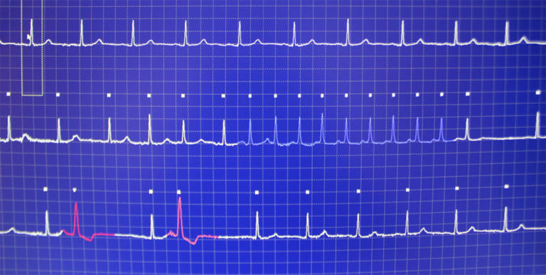 Heart Flutter - Cardiology Specialists